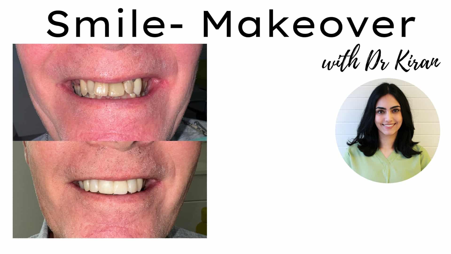 Mark's Smile Makeover - Composite Bonding - Aloe Vera Dental Studio